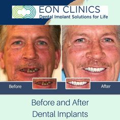 angion method before and after | Topic